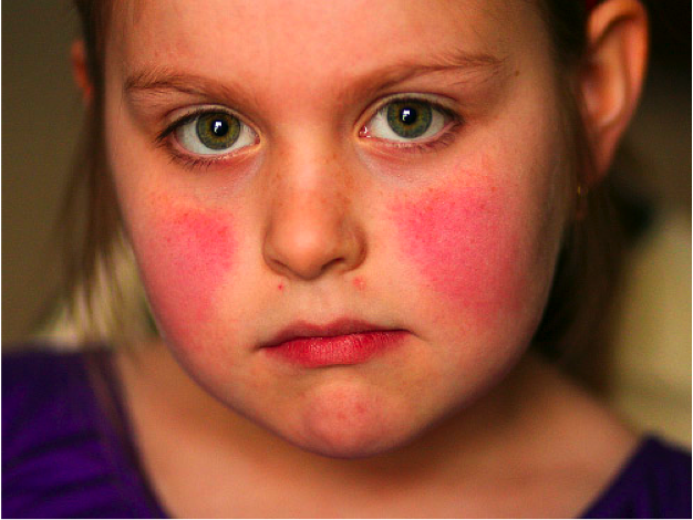 23 każ ta' 'Slapped Cheek Syndrome' matul din is-sena