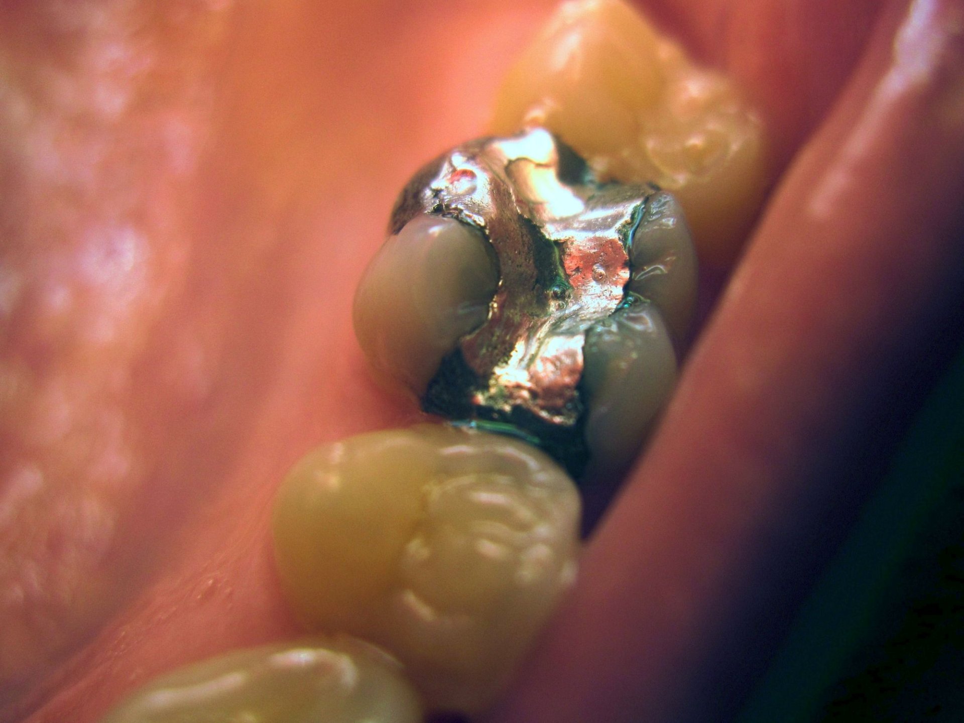 Countries agree to end mercury tooth fillings by 2034